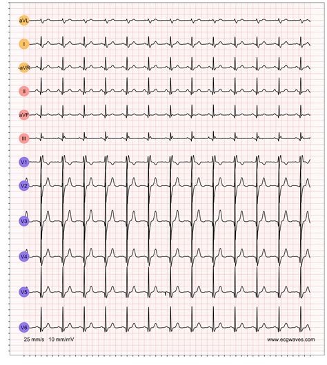 Ecg Waves What Is The Conduction Defect And Would It