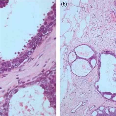 Between Multifocal Multicentric Invasive Tumors And Distance Of Download Scientific Diagram