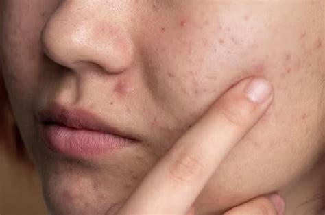 Tak Perlu Repot Keluar Kocek Dalam Ini Cara Mudah Atasi Jerawat Dengan Bawang Putih Nakita