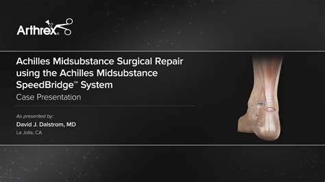 Arthrex Achilles Midsubstance Surgical Repair Using The Achilles