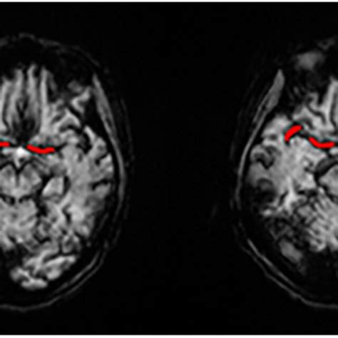 Arterial Input Function Aif Curve Extracted From Time Series The Red