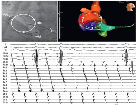 Atrial Flutter Thoracic Key