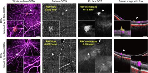 Utility Of En Face Oct For The Detection Of Clinically Unsuspected Retinal Neovascularization In
