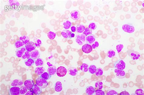 Acute Promyelocytic Leukemia Cells 이미지 1417347915 게티이미지뱅크