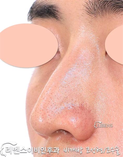 비개방 코성형 남자 코끝 성형 수술 코끝연골 재배치 묶기 전후사진 S1224