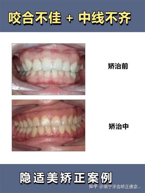 南宁牙齿矫正 【咬合不佳 中线不齐】矫正前后变化 知乎