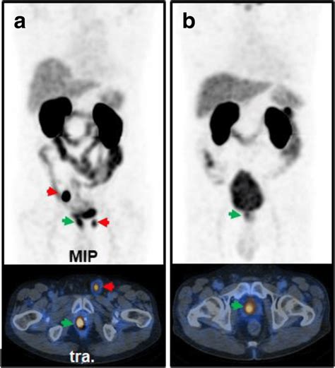 [99mtc]tc Psma Iands Spect Ct In Primary High Risk Pca A 71 Year Old Man Download Scientific