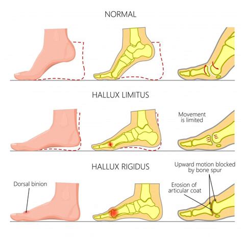 Bone Spurs On Big Toe Of Foot Store