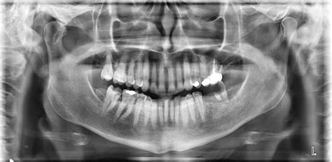 Cidem Torus Mandibular