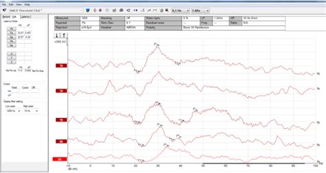 Eclipse Middle Latency Response Mlr Interacoustics