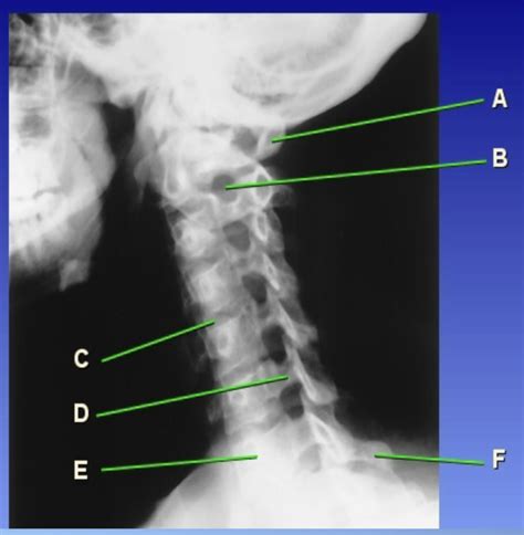 Obl C Spine Diagram Quizlet