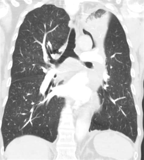 Luftsichel Sign Radiology Signs