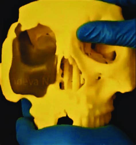 lock and key type fitting by preoperative mirroring from normal side
