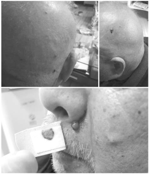 卡瑞利珠单抗致反应性皮肤毛细血管增生症1例 Word文档在线阅读与下载 无忧文档