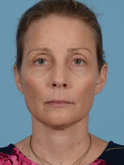 Page 4 Facelift Gallery Dr Henry A Mentz