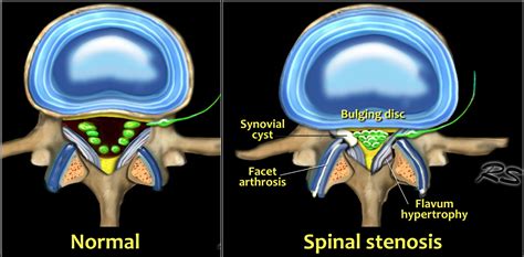 Lumbar Disc Herniation Foraminal Stenosis At Ruby Dougharty Blog