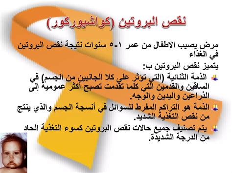 أمراض سوء التغذية عند الأطفال Pdf