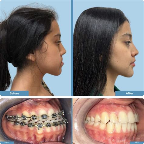 Orthognathic Jaw Surgery Staten Island Oral Surgery