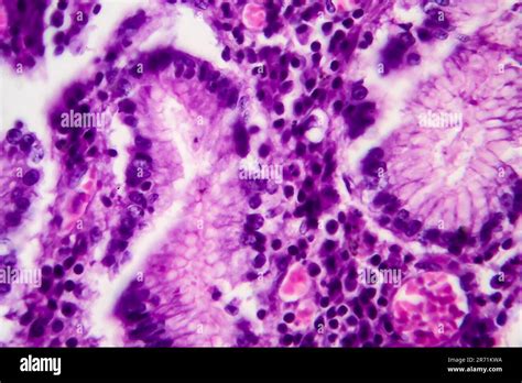 Histopathology Of Stomach Adenocarcinoma Light Micrograph Photo Under