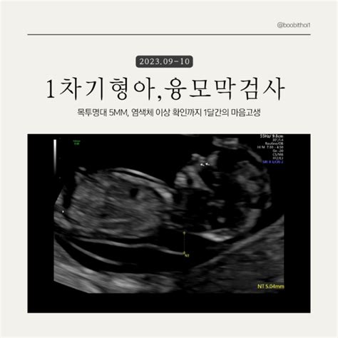 1차 기형아검사 Nt목 투명대 5mm 융모막검사 및 결과