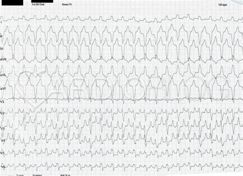Xiv 3 Non Ischaemiás Dcm Cardio Blog