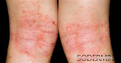 Bệnh Chàm Eczema Và Những điều Bạn Cần Biết