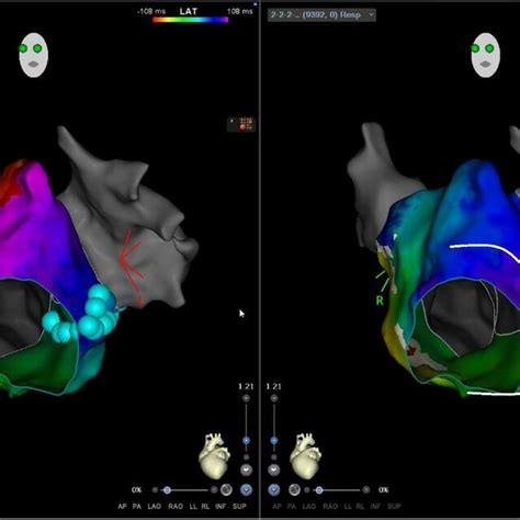 First Time Pulmonary Vein Isolation Pre Ablation And Post Ablation