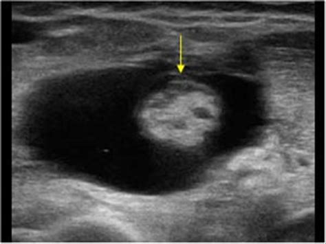 Musculoskeletal Joints And Tendons 6 1 Shoulder Case 6 1 2 Biceps Tendon Rupture