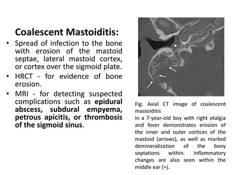 Mastoid Diseases Imaging Pptx