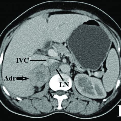 Computed Tomography Scan Revealing Right Adrenal Mass With Large