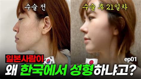 ️드디어 성형하러 한국에 왔습니다 ️ [k성형vlog 1부] 한국 성형후기 일본 Youtube