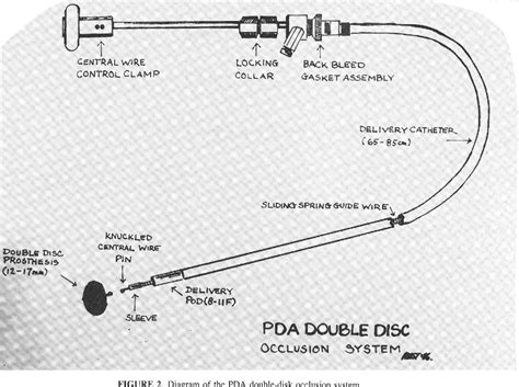 Figure 1 From Nonsurgical Closure Of Patent Ductus Arteriosus Clinical Application Of The