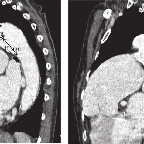 A Postoperative Ct Indicating Closed Patent Ductus Arteriosus Pda Download Scientific