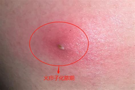 火疖子各个时期的图片