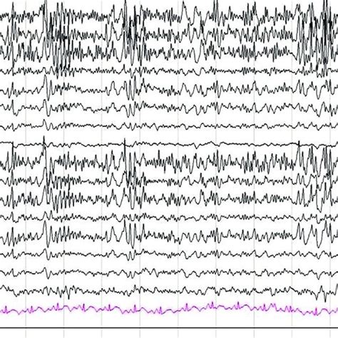electroencephalogram was grossly abnormal showing diffuse background