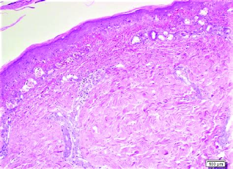 Histopathology Of Livedoid Like Rash There Was Vascular Dilatation And