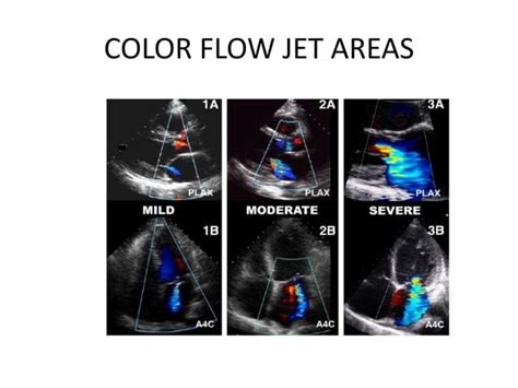 Echocardiographic Evaluation Of Mitral Regurgitation PPTX