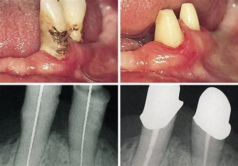 Tooth Gangrene Causes Symptoms Treatment Consequences Healthy