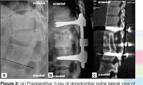 Figure 3 From Simultaneously Anterior Decompression And Posterior