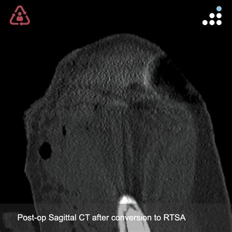 Orthobullets On Twitter Post Op Ct Scan After Conversion To Rtsa