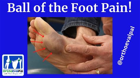 Pain On Bottom Outside Of Foot Sale