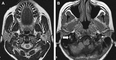 Imaging Of Temporal Bone Tumors Neuroimaging Clinics
