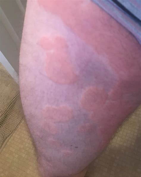 Didnt Realise I Had This Rskeetersyndrome