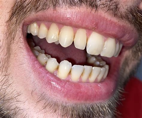 Teeth Discoloration Enamel Erosion Between Teeth Raskadentist