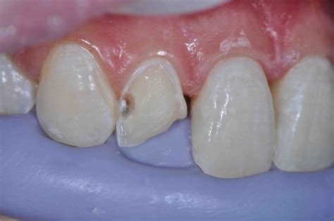 Comparing Translucency Composite And Natural Teeth Lee Ann Brady Dmd