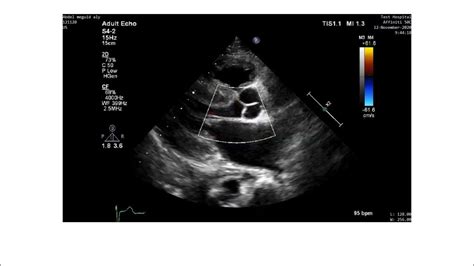 How To Diagnose Amyloidosis By Echocardiography Youtube