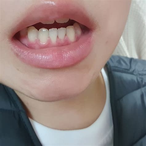 교정 잇몸퇴축 지식in