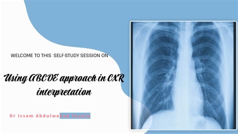 Abcde Approach For Cxr Interpretation Genially