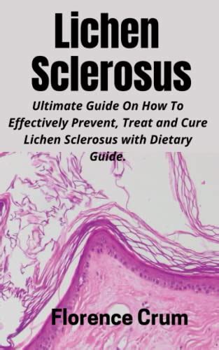 Buy Lichen Sclerosus Ultimate Guide On How To Effectively Prevent