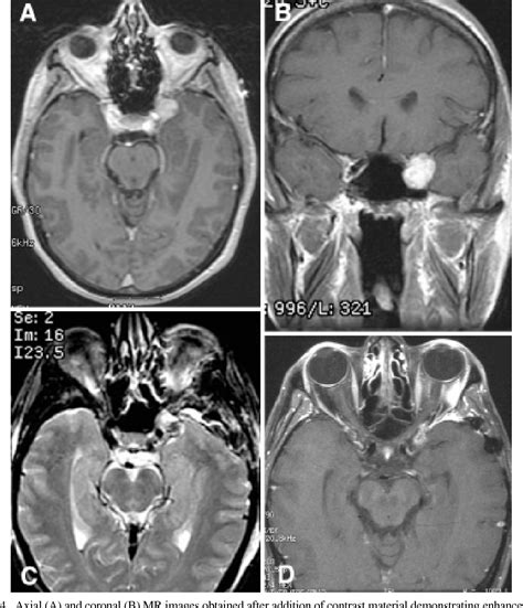 Figure 4 From Are Cavernous Sinus Hemangiomas And Cavernous